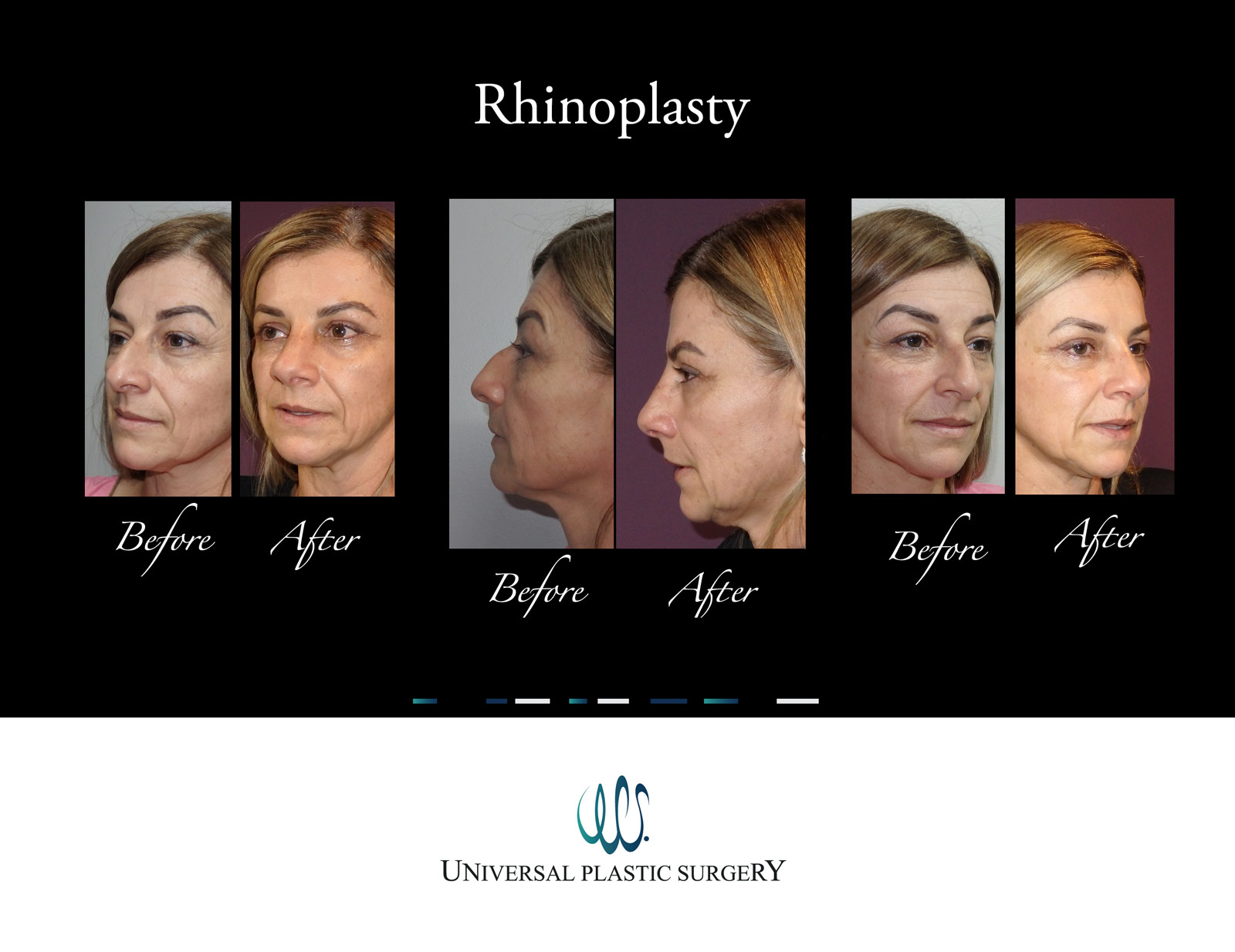 Rhinoplasty - Nose Surgery